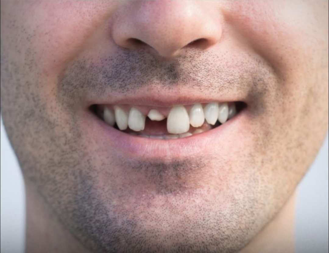 World’s First Human Trial Begins for Revolutionary Tooth-Regrowing Drug ...